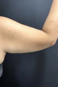 Before & After Upper Arms Procedures in Santa Monica | Self Care LA