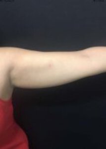 Before & After Upper Arms Procedures in Santa Monica | Self Care LA