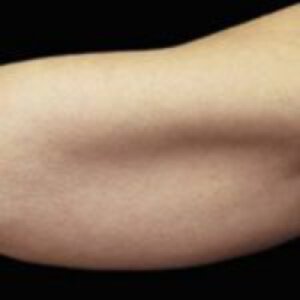 Before & After Upper Arms Procedures in Santa Monica | Self Care LA