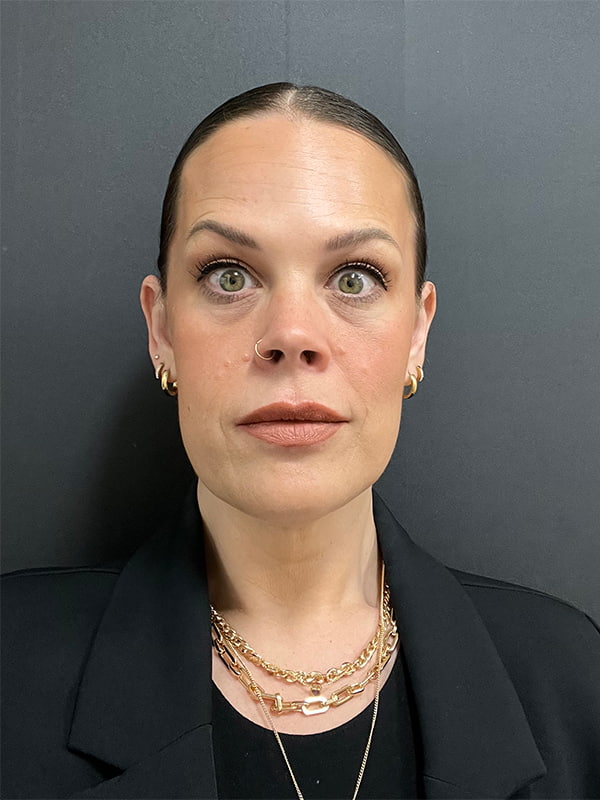 Botox Santa Monica, CA | Botox® Injections Santa Monica