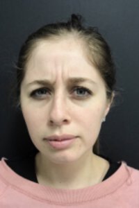 Before & After Botox Procedures in Santa Monica | Self Care LA