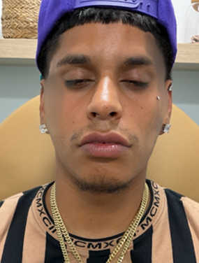 Dermal Fillers Santa Monica, CA | Fillers Santa Monica